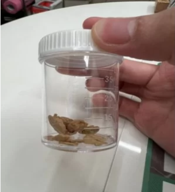 Caso de acumulação de 30 anos de esmegma em pênis surpreende equipe ...
